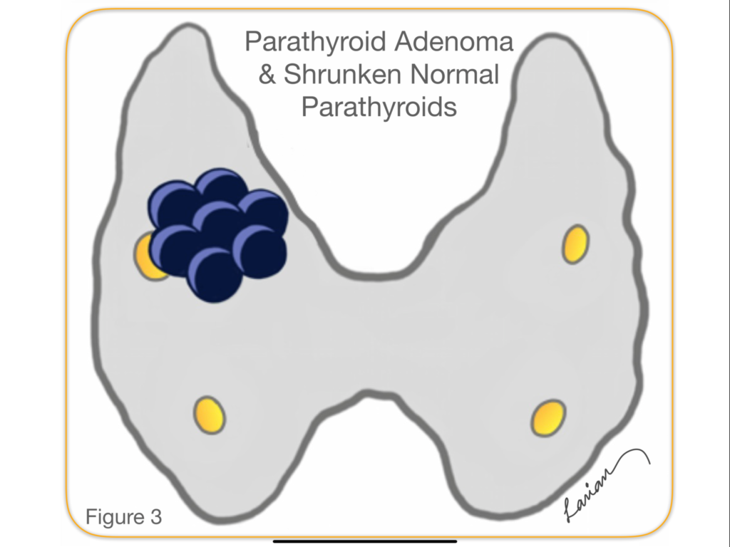 Figure 3 - Hyperparathyroidism Surgery - Dr. Babak Larian