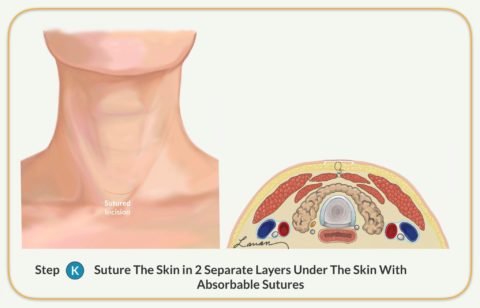 Parathyroidectomy - Parathyroid Gland Removal Surgery | Dr. Larian